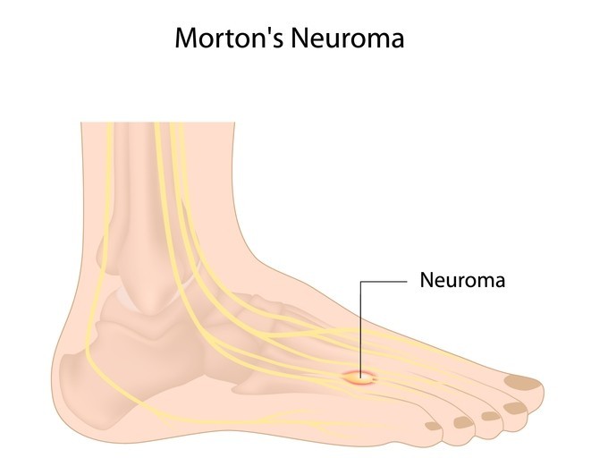 Morton's Neuroma | Foot Neuroma Treatment and Surgery | Extend