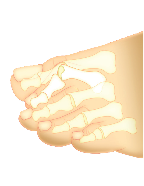 4 Ways to Reverse Hammertoe Without Surgery